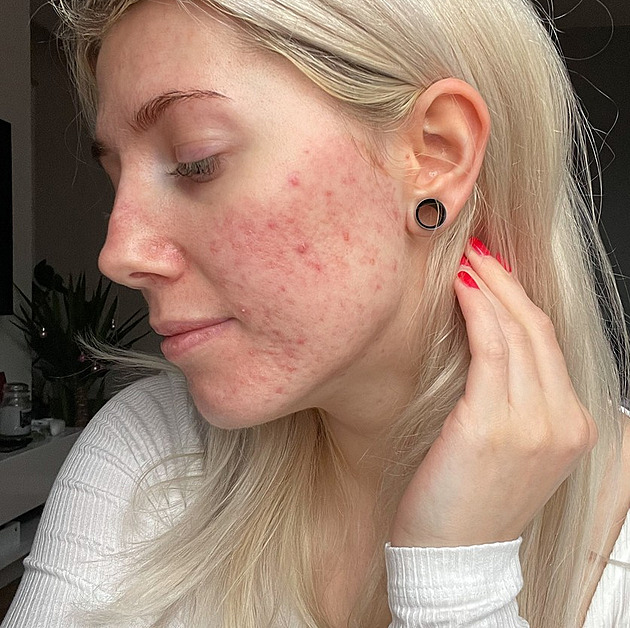 S akné jsem se smířila až díky sociálním sítím, říká žena - iDNES.cz