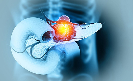 Nová naděje v léčbě rakoviny slinivky. Pomoct by měl krevní test - iDNES.cz
