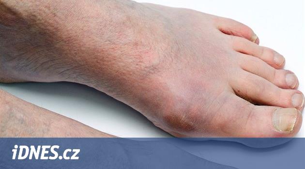 Nemoc králů: co se děje s vaším tělem, když máte dnu - iDNES.cz