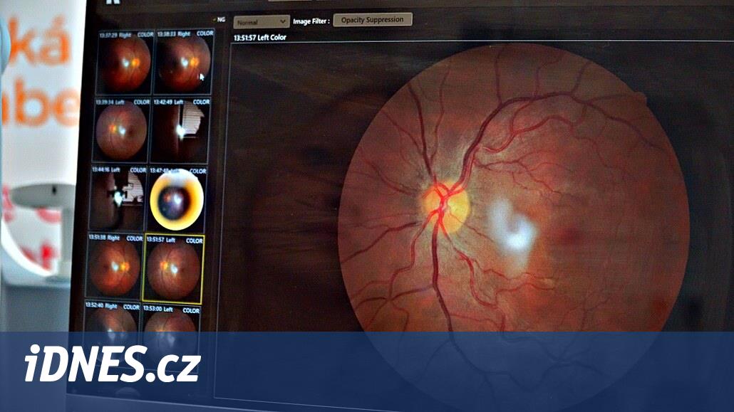 Když vám nemoc kouká z oka, umělá inteligence ji odhalí - iDNES.tv