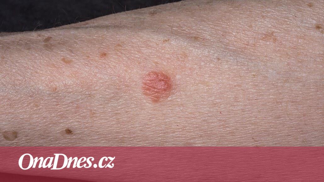 Šupiny na kůži nepodceňujte. Může to být rakovina, varují lékaři - iDNES.cz